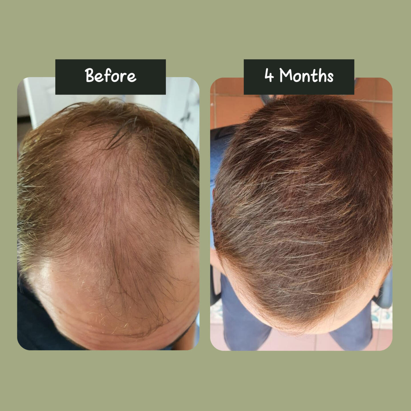 &BAM Hair Loss Results