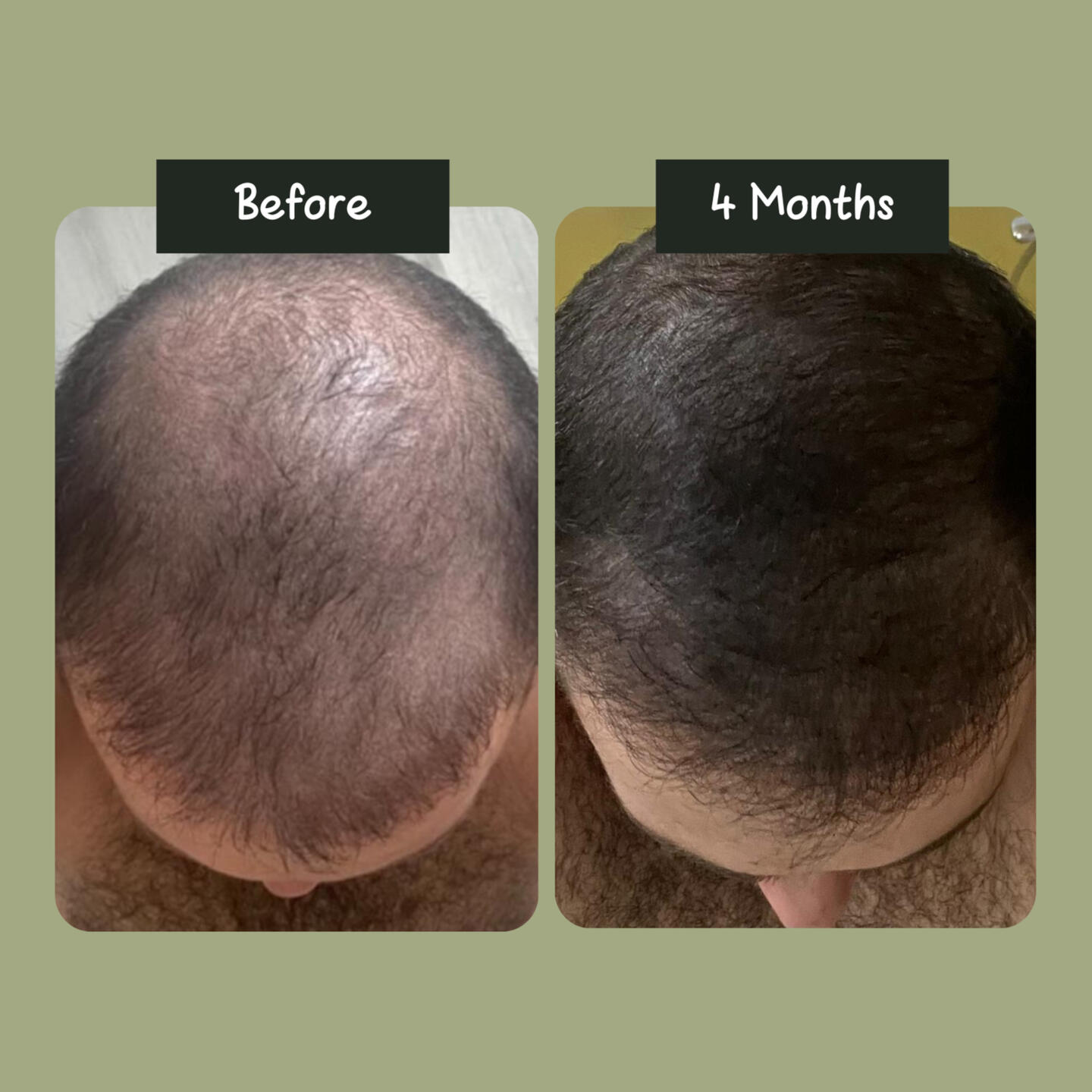 &BAM Hair Loss Results